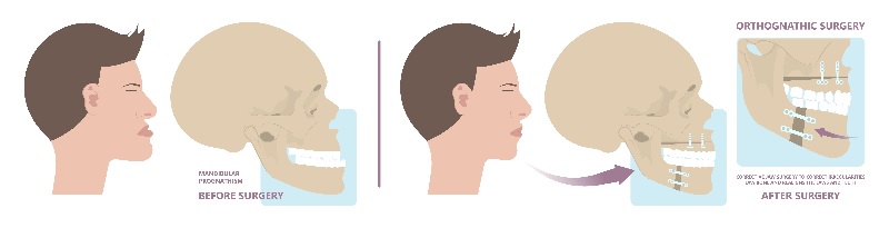 Quando o padrão III (três) de face necessita de cirurgia ortognática ...