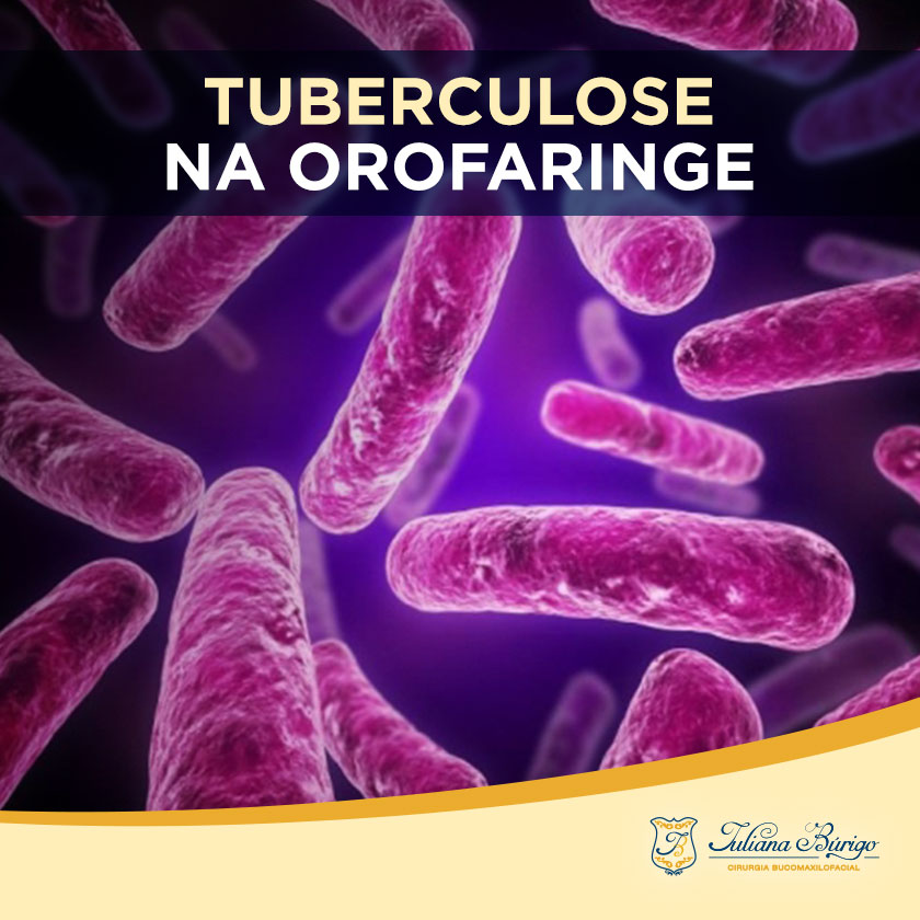 Tuberculose na Orofaringe – Juliana Búrigo
