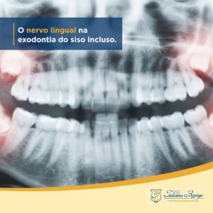 O nervo lingual na exodontia do siso incluso – Juliana Búrigo