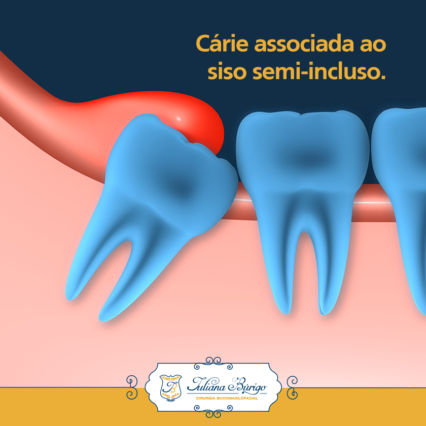 Cárie associada à presença de terceiro molar semi-incluso – Juliana Búrigo