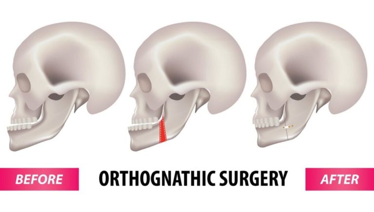 O que é cirurgia ortognática? Saiba tudo sobre o procedimento ... O que é cirurgia ortognática? Saiba tudo sobre o procedimento ...