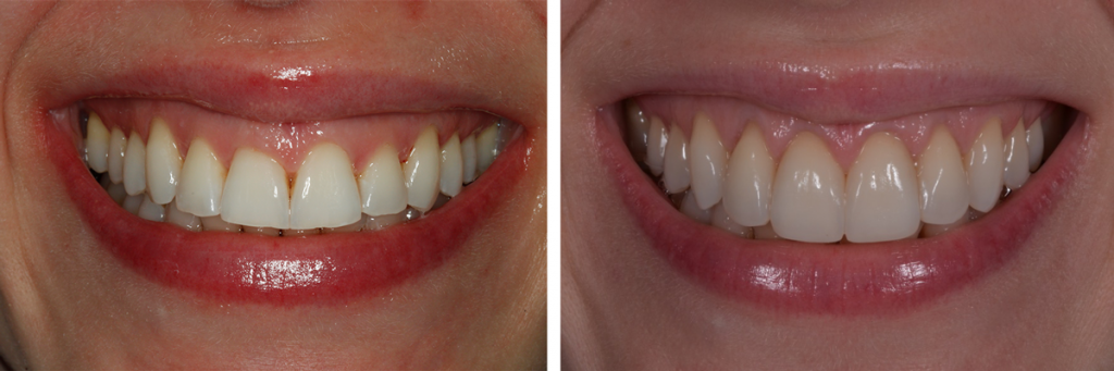 Cirurgia Plástica Periodontal: procedimento para um sorriso mais ...