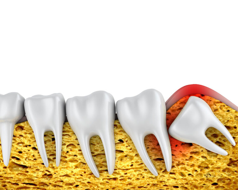 Quando devo tirar o siso? – Juliana Búrigo