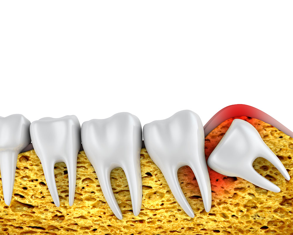 Quando devo tirar o siso? – Juliana Búrigo