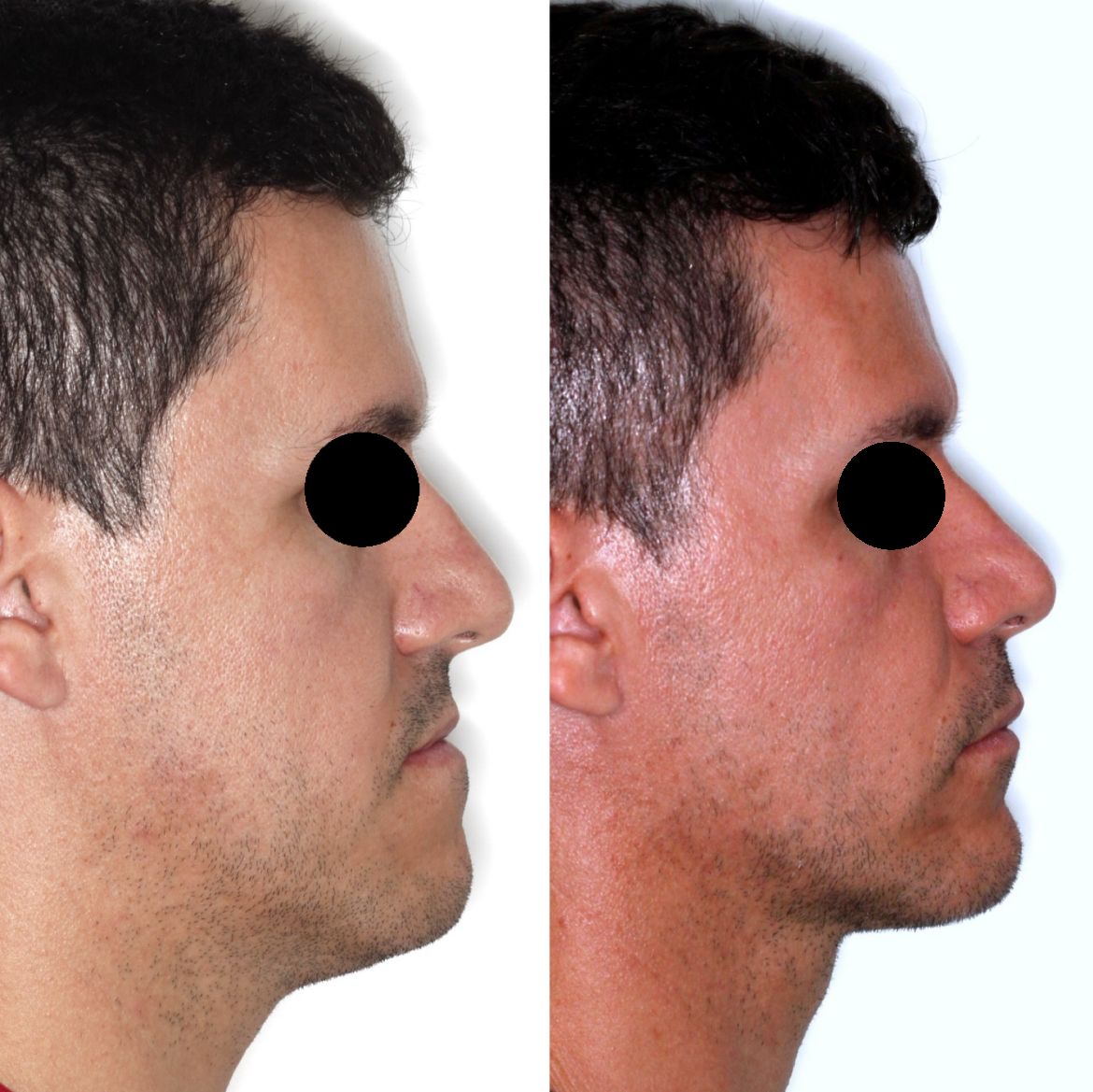 Cirurgia Ortognática Padrão Classe 3: tudo o que você precisa saber ...